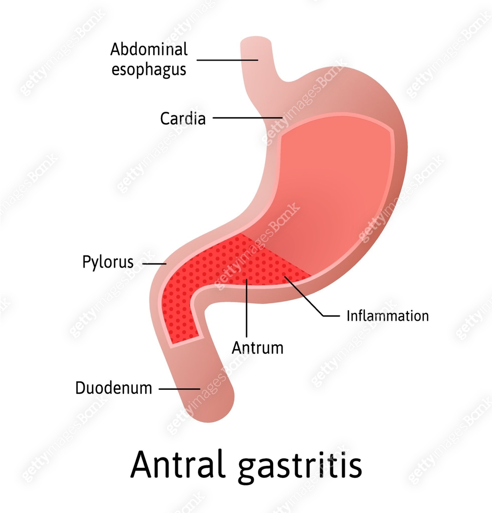 Antral Location Of Gastritis An Inflammation Of The Lining Of The